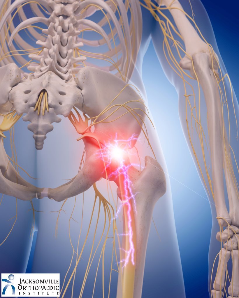 Sciatic Nerve Pain
