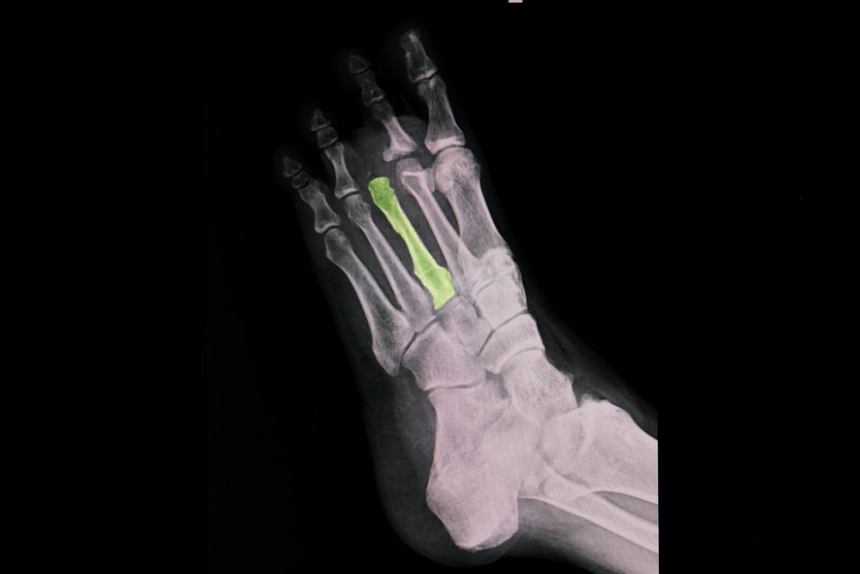 Metatarsal Fracture: Diagnosis and Treatment Options