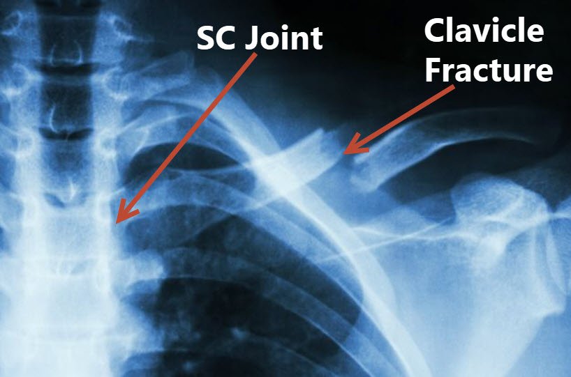 Sternoclavicular Joint Disorder
